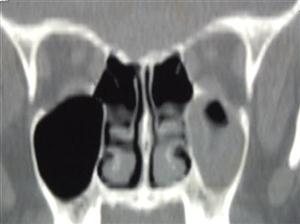 Doctor Galindo, Rinoplastia : Cirugía endoscópica nasosinusal: La ...